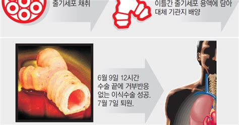 환자 줄기세포 이용한 인공기관지 이식 성공