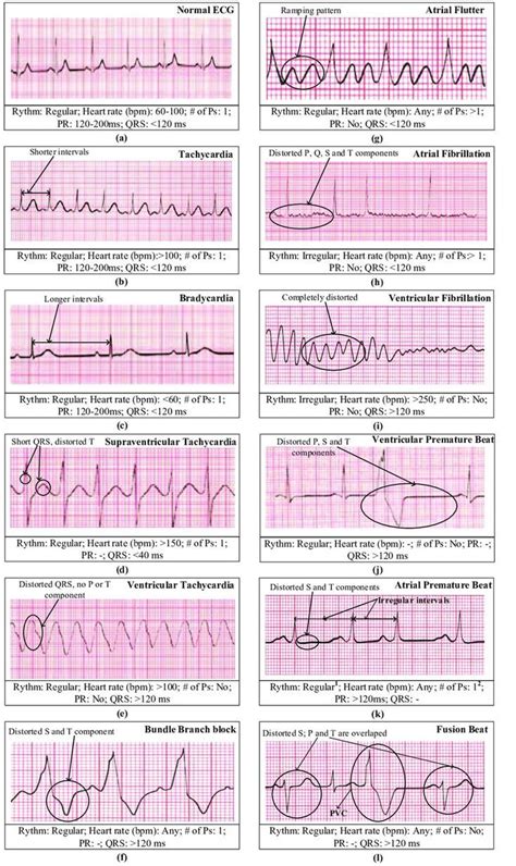 Cardiac Dysrhythmias Pdf Electrocardiography Cardiovascular System