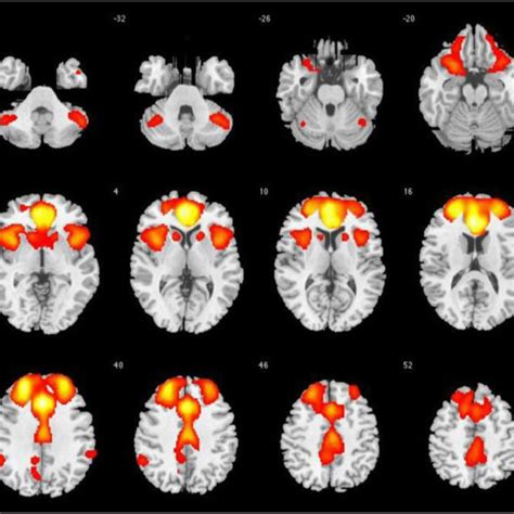 Abnormal Functional Connectivity Of Salience Network Rois In The Fes Download Scientific