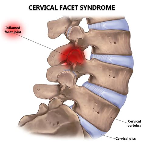 Cervical Facet Syndrome Nj And Nyc