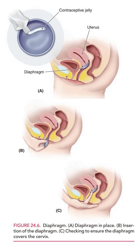 Diaphragm Vs Cervical Cap Diaphragm Cervical Cap And Vaults Are