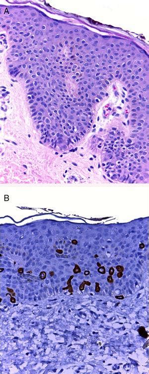Clear Cell Papulosis A Case Series Actas Dermo Sifiliográficas