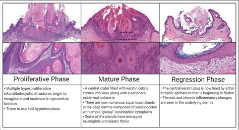 Keratoacanthoma Histology