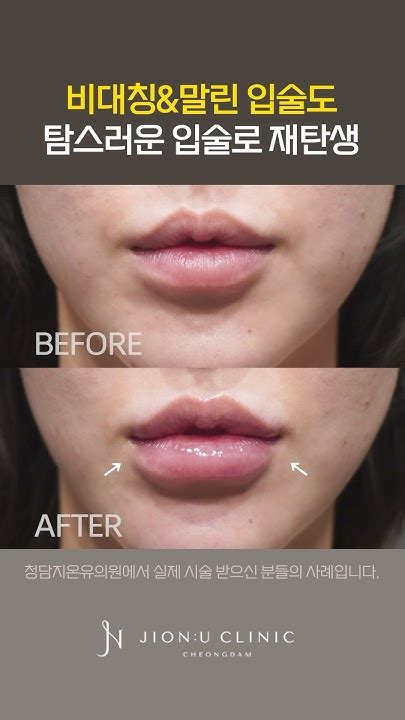 비대칭and말린 입술도 탐스러운 입술로 재탄생🍒입술필러 입꼬리필러 오버립 강남필러 강남피부과 입꼬리보톡스 쥬비덤