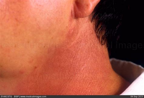 Stock Image 1324099 01a8cstq Bsip Search Medical And Scientific