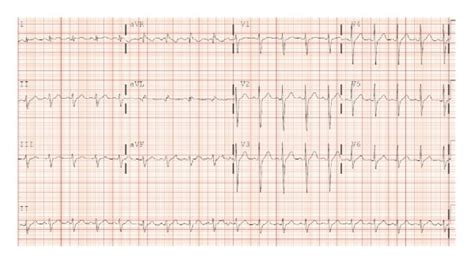 Ecg Axis Deviation Chart Ekg Anatomy Axis From Life In The Fast Lane Medtx Right Axis