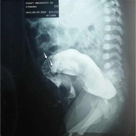 Shows A Low Descending Colostomy That Demonstrates Four Stomas POD Download Scientific