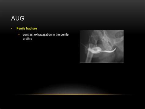 Ascending Urethrogram PPTX
