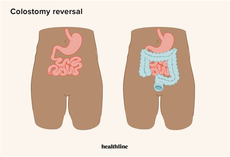 Colostomy