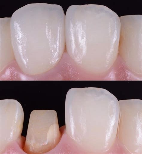 Туяарах дент шүдний эмнэлэг Металл шаазан бүрээс Pfm ☎️9️⃣6️⃣0️⃣1️⃣3️⃣2️⃣2️⃣5️⃣ Facebook