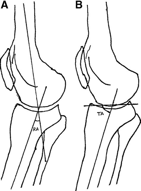A The Recurvatum Angle Ra And B Tibial Plateau Angle Ta