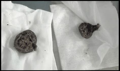 Rectal Bezoar A Rare Cause Of Intestinal Obstruction Abstract Europe Pmc