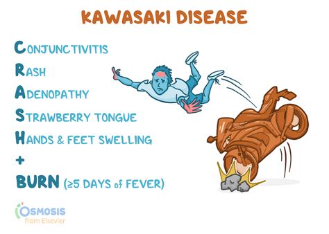 Crash And Burn Kawasaki Disease Signs And Symptoms Acronym Osmosis