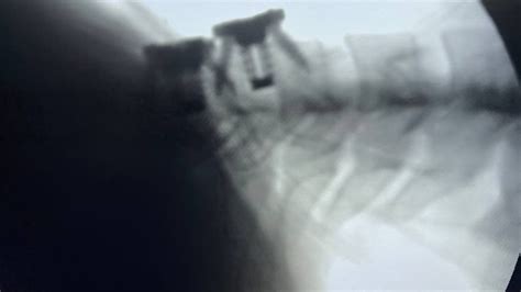 Understanding Transforaminal Epidural Steroid Injection Tfesi What You Need To Know