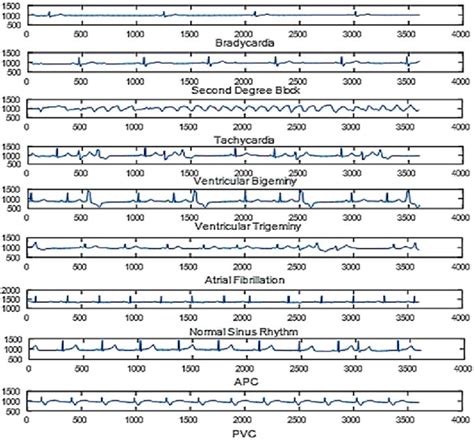 Figure 1 From A Universal Ecg Signal Classification System Using The