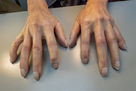 Female Patient Hands With Scleroderma Stock Image Image Of Illness Healthcare 339271661