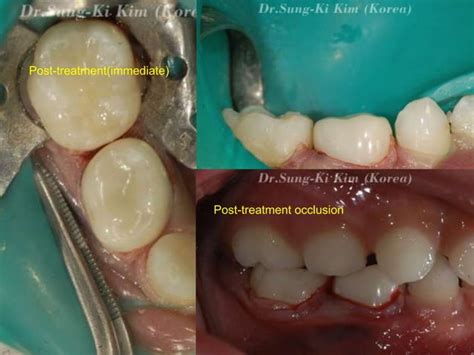 Restoring Primary Anterior Teeth With Esthetic Crowns Pptx Dental