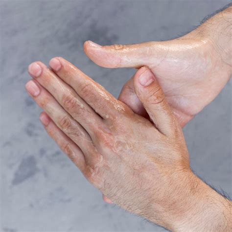 Palmar Hyperhidrosis Causes Complications Risk Factors Diagnosis