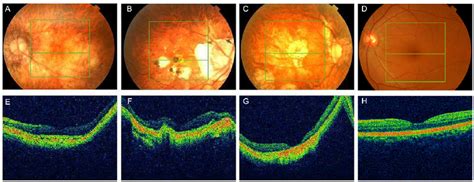 Fundus Photographs And Optical Coherence Tomography Oct Of High