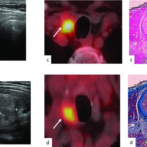 Neck Us Showed A 22 Mm Hypoechoic Solid Nodule Of The Right Thyroid Download Scientific Diagram