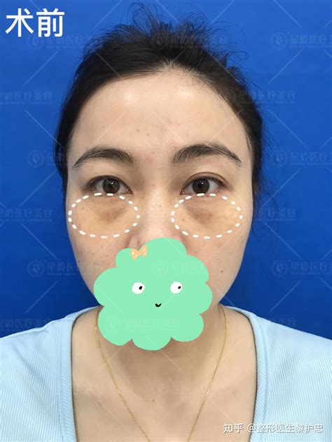 内切祛眼袋和外切祛眼袋该如何选择 知乎