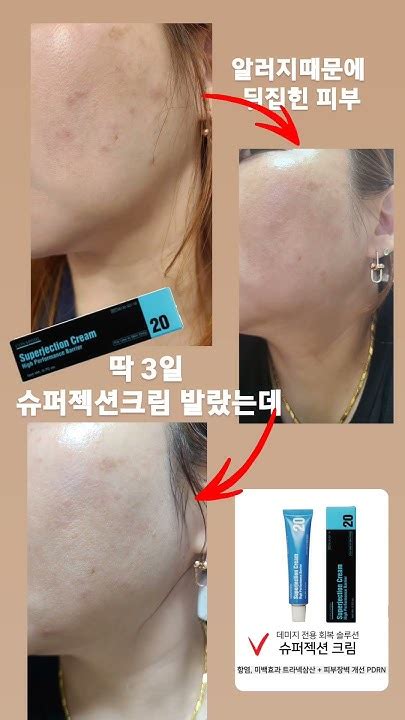 비염에 천식에 접촉성피부염에 햇빛알러지까지 욕심쟁이라 다 가진 한원장 슈퍼젝션크림 듬뿍 발랐어요 문제성피부 피부장벽강화 연어주사크림 레이저시술후 알러지기미색소