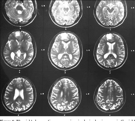 Figure 1 From Generalized Morphea Following Radiotherapy For An