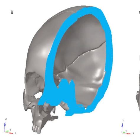 A Bonded Acrylic Cap Splint Expander B Hybrid Expander C Bone Borne