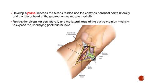 Proximal Tibia Surgical Approaches Pptx