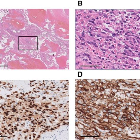 Intraoperative Findings A Partial Liver Resection Of S4 And S1 With Download Scientific
