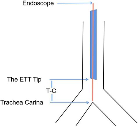 The Distance Between The Ett Tip And The Carina T C Download Scientific Diagram