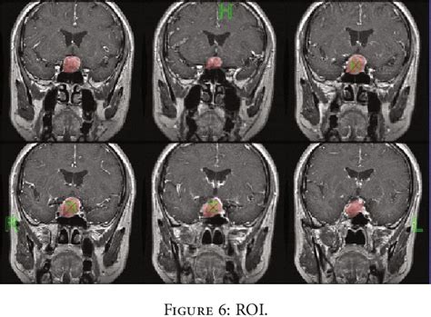 Figure From MR Image Classification For Brain Tumor Texture Based On Pseudo Label Learning And