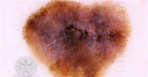 Invasive Melanoma Dermoscopy Breslow 04mm Within A Melanoma In Situ