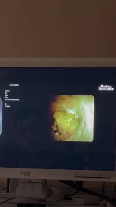 ahmad abu ayyash on linkedin ercp cholangioscopy spyglass endoscopy gastroenterology