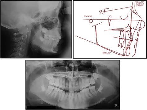 Class Ii Correction Extraction Or Nonextraction Pocket Dentistry