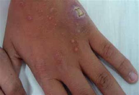 Vesiculopustular Lesions Of Varicella Around Leishmaniasis Ulcer On The Download Scientific