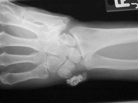 Transformation Crest Syndrome With Scleroderma Telangiectasias And