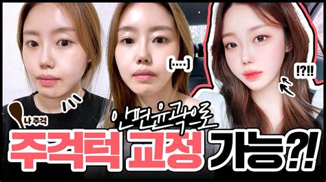 윤곽으로 주걱턱 없애고 다른 인생 사는 중 성형전후 성형브이로그 Youtube