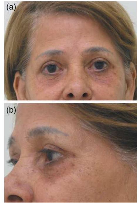 Pdf What Causes Dark Circles Under The Eyes