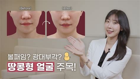 광대툭튀 땅콩형 얼굴에서 베이비페이스 되는 방법 볼꺼짐 옆광대 울퉁불퉁 얼굴형 해결 Youtube