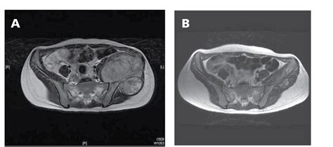 Pelvic Tumor
