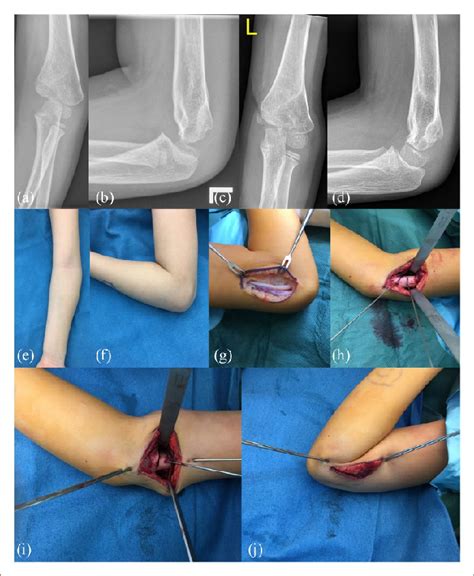 An Illustrative Case Of A Three Dimensional Corrective Osteotomy Is Download Scientific Diagram