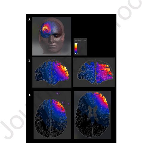 Figure 1 From Targeted Non Invasive Brain Stimulation Boosts Attention