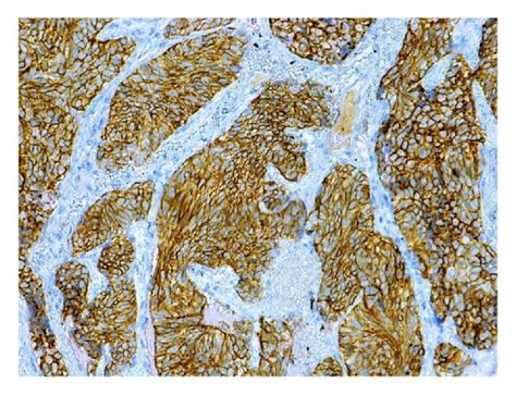 Case 2 A Carcinoid Tumor B Carcinoid With Strong And Diffuse Download Scientific Diagram