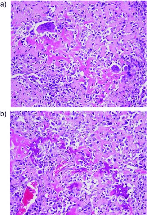 A Osteoclast Like Giant Cells And Pleomorphic Tumor Cells Are