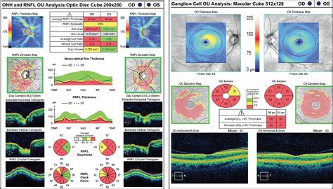 Glaucoma Westfield Eye Center