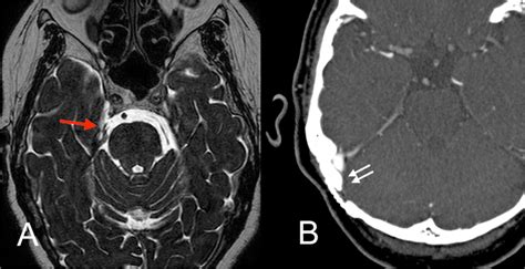 Trigeminal Nerve Mri Syphilis Mimicking Trigeminal Schwannoma