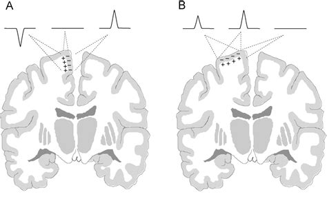 Figure 5 From Paradoxical Lateralization Of Non Invasive Electroencephalographic Ictal Patterns
