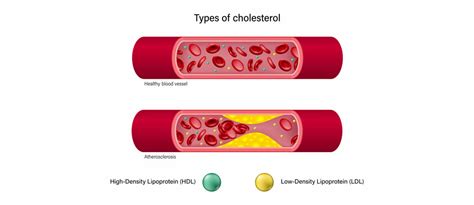 Hdl Vs Ldl What Is The Difference Between Hdl And Ldl Cholesterol