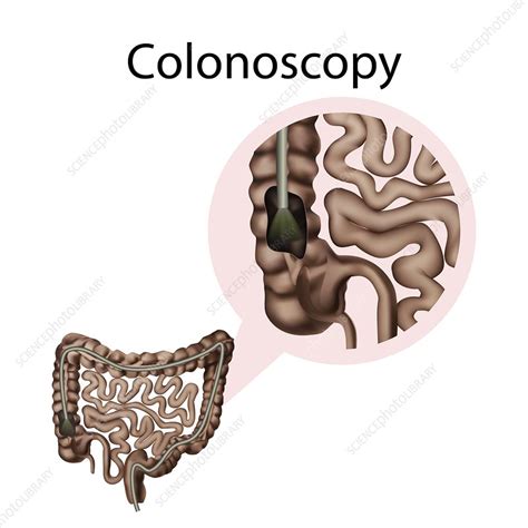 Colonoscopy With Endoloop At Debra Boardman Blog